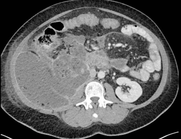 Minimal-invasive percutaneous step-up approach compared to endoscopic ...