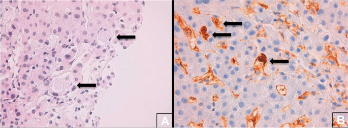 Obliteration of liver sinusoids through platelet aggregates associated ...