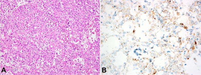 Renal Epithelioid Angiomyolipomas Overexpress Tfe3 And The Tfe3