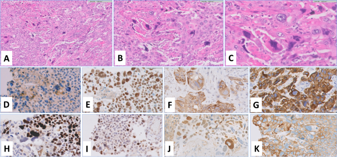 Giant cell carcinoma of the urinary bladder | Virchows Archiv