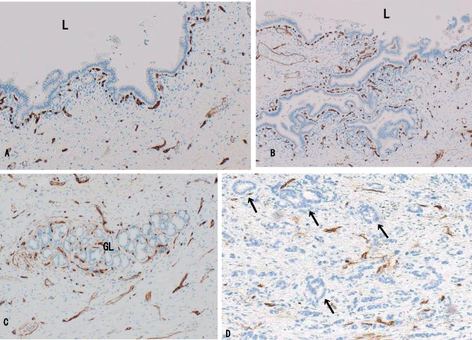 Pathologic characterization of precursors and cholangiocarcinoma ...