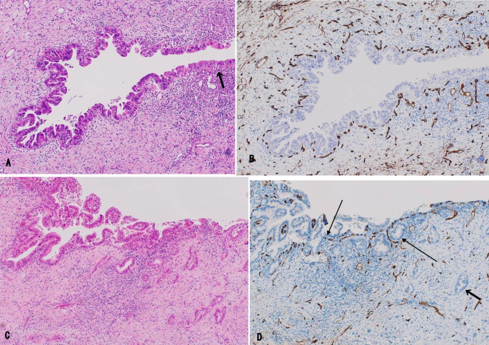 Pathologic characterization of precursors and cholangiocarcinoma ...