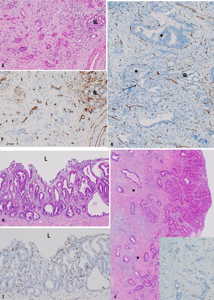 Pathologic characterization of precursors and cholangiocarcinoma ...