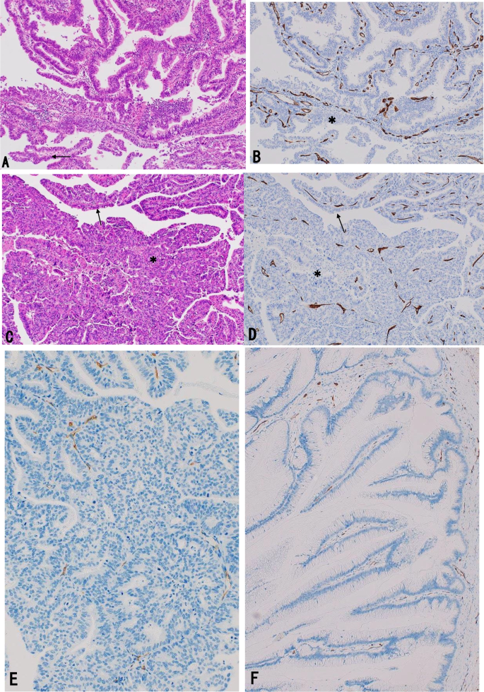 Pathologic characterization of precursors and cholangiocarcinoma ...