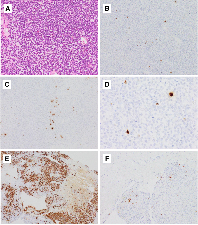 MUC5AC immunoreactivity in scattered tumor cells is useful for ...