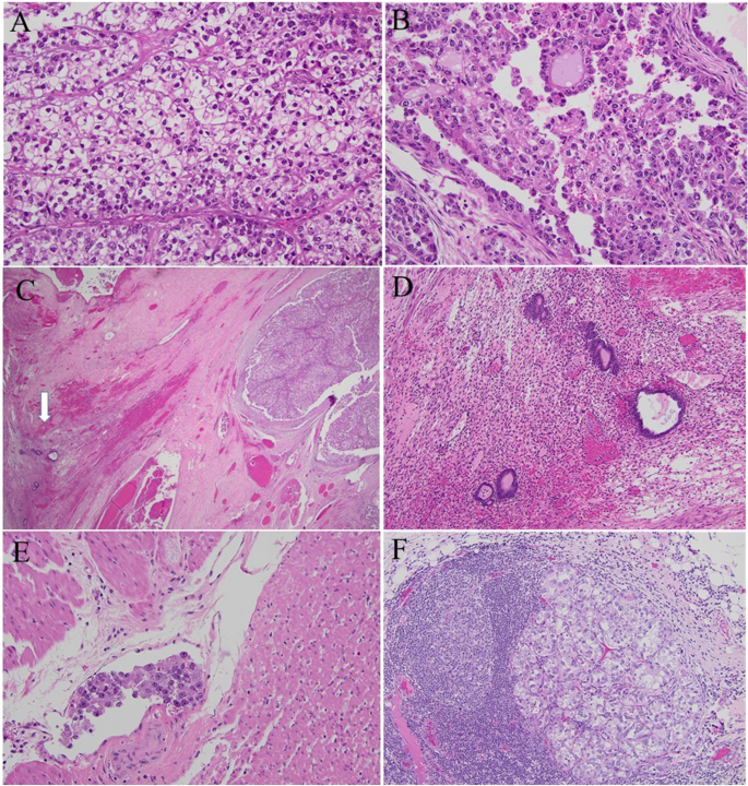 Müllerian clear cell carcinoma arising from rectal endometriosis with ...
