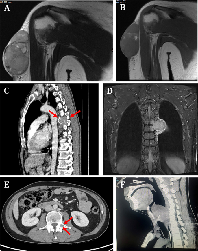 EWSR1::ATF1 fusions characterize a group of extra-abdominal epithelioid ...