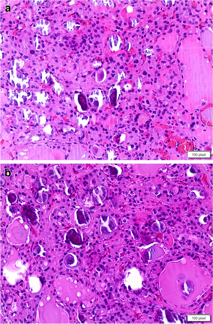 Psammoma bodies in thyroid: are they always indicative of malignancy? A ...
