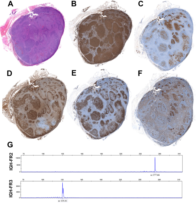 Pediatric lymphomas: overview and diagnostic challenges | Virchows Archiv