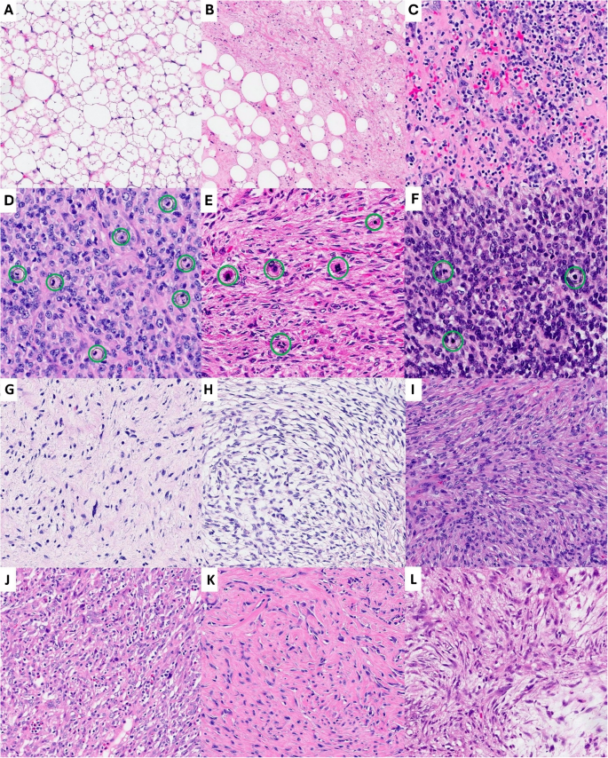 Can Dedifferentiated Liposarcoma be Reliably Excluded Based on Mitotic ...