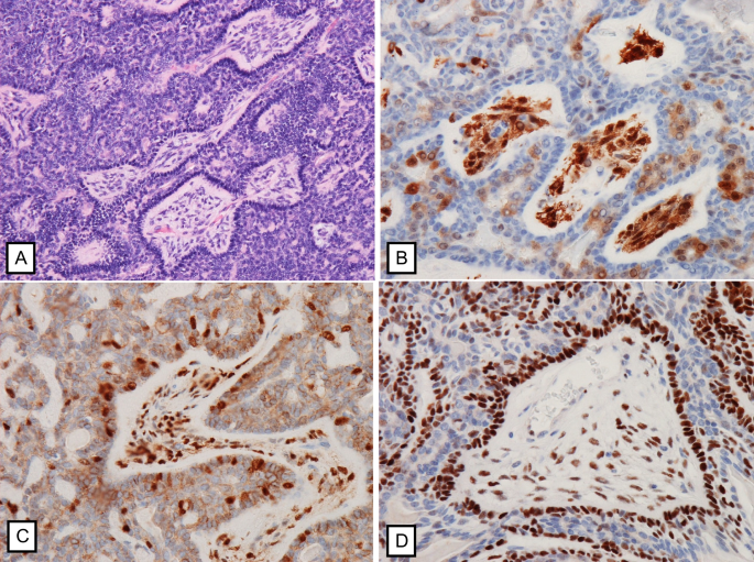 S100-positive stroma in salivary gland basal cell adenoma: recent ...
