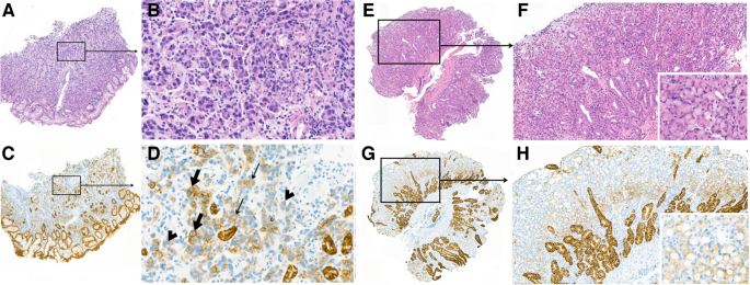 CLDN18.2 expression in gastroesophageal adenocarcinoma: prevalence ...
