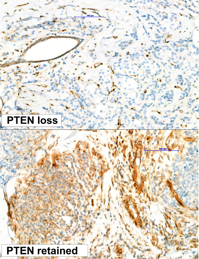 Immunohistochemistry for PTEN testing in HR +/HER2˗ metastatic breast ...