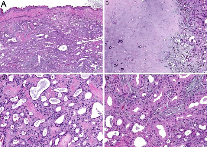 Targeted molecular profiling uncovers true ceruminous adenomas with ...