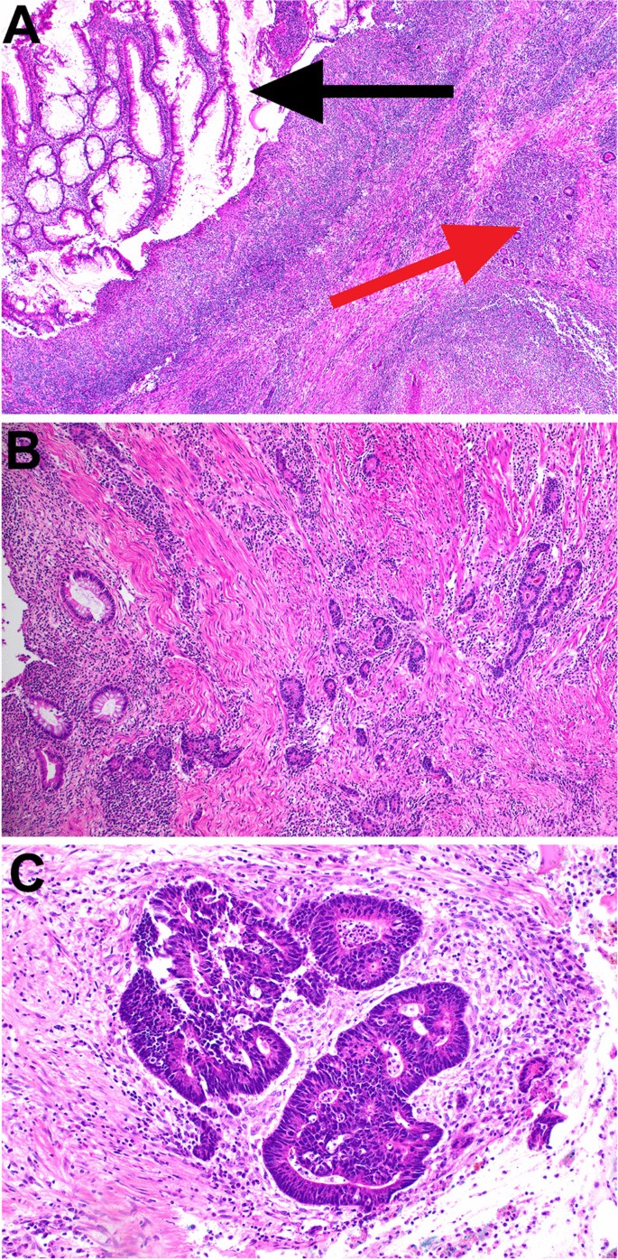 A paired sequencing study of goblet cell adenocarcinomas with ...