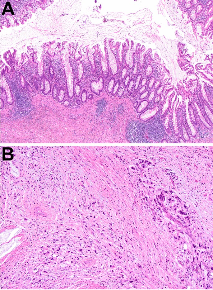 A paired sequencing study of goblet cell adenocarcinomas with ...