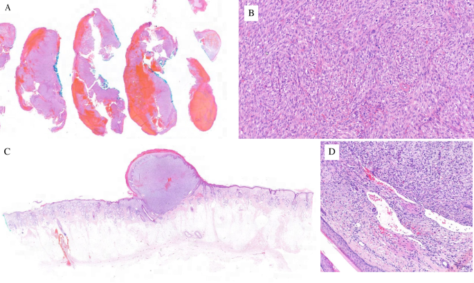 Undifferentiated melanoma: a molecular study of a fatal metastatic ...