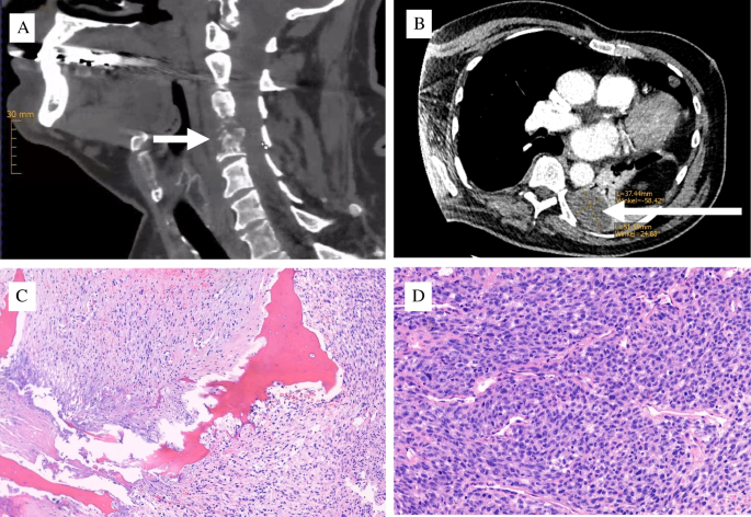 Undifferentiated melanoma: a molecular study of a fatal metastatic ...