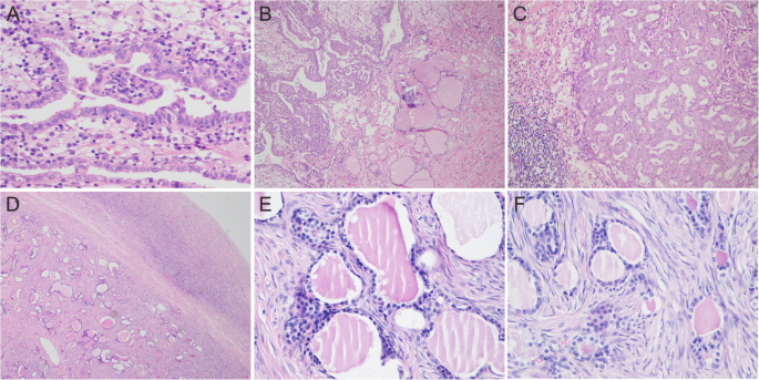 Malignant struma ovarii: clinicopathological and molecular features in a series of nine cases ...