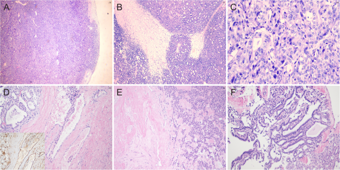 Malignant struma ovarii: clinicopathological and molecular features in a series of nine cases ...