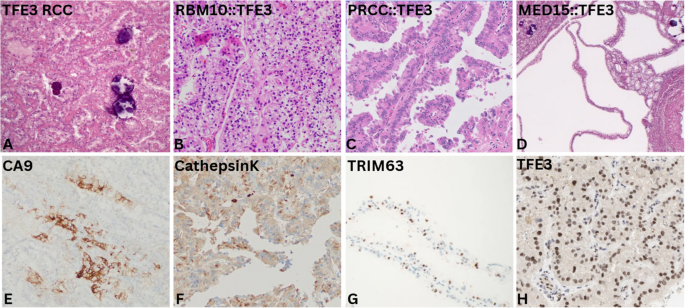 TFE3 rearranged renal cell carcinoma: a diagnostic guide for daily ...