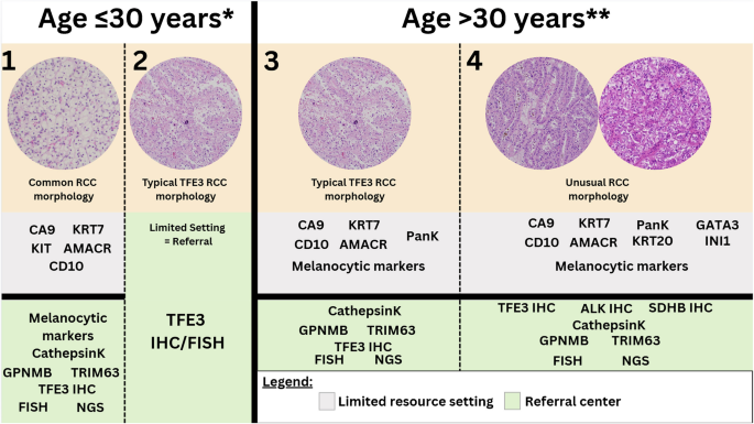 TFE3 rearranged renal cell carcinoma: a diagnostic guide for daily ...