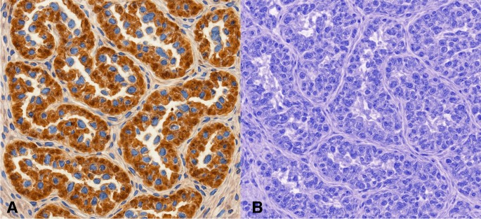 The prognostic value of CLDN18.2 expression in pancreatic ductal ...