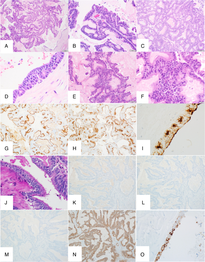 A rare cystic and papillary variant of acinar cell carcinoma with liver ...