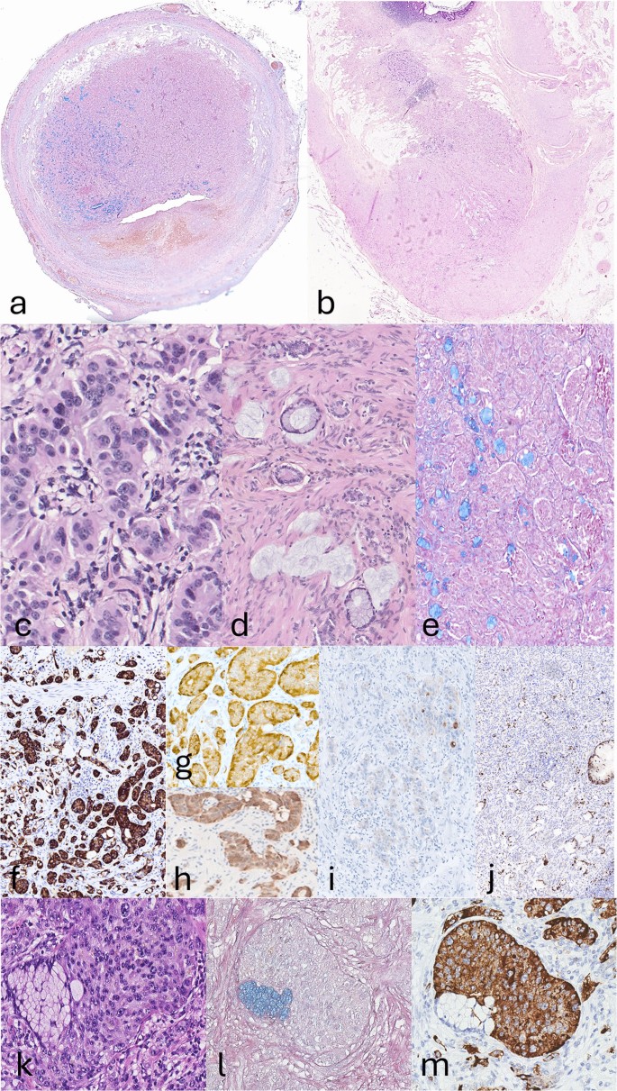 Combined neuroendocrine tumor and goblet cell adenocarcinoma of the ...