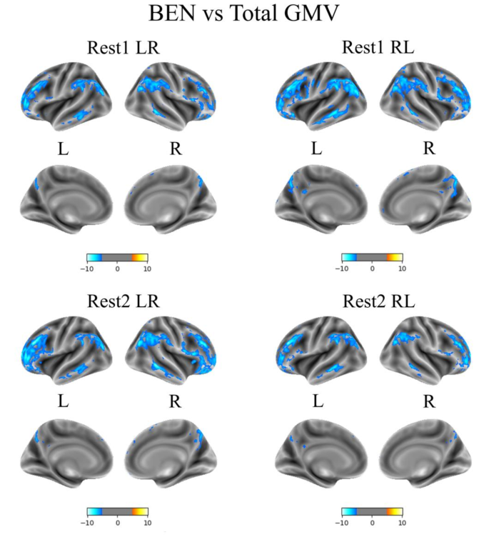 rsfMRI-based brain entropy is negatively correlated with gray matter ...