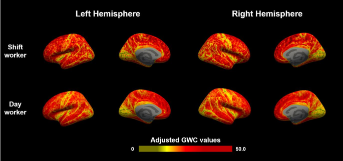 Altered cortical myelination based on gray-to-white matter signal ...
