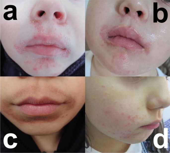 Periorificial dermatitis in infants and preschoolers – a narrative ...