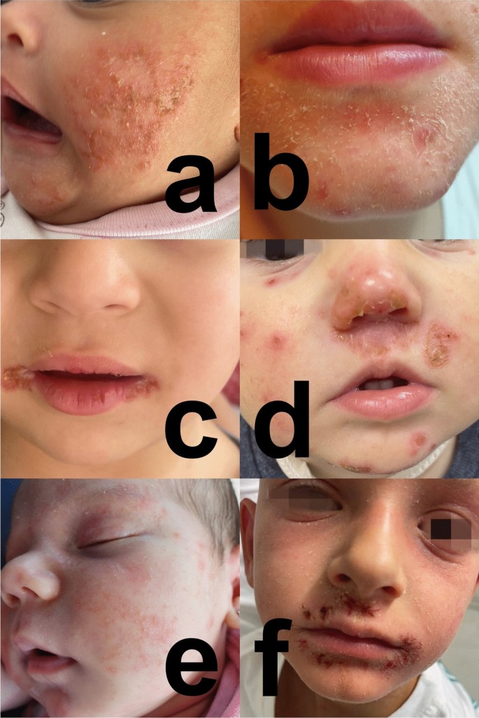 Periorificial dermatitis in infants and preschoolers – a narrative ...