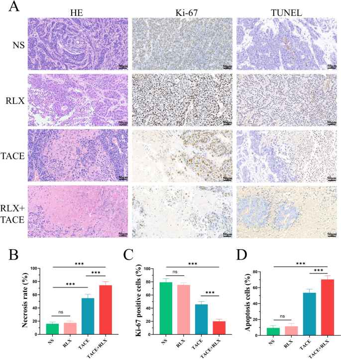 Relaxin combined with transarterial chemoembolization achieved ...