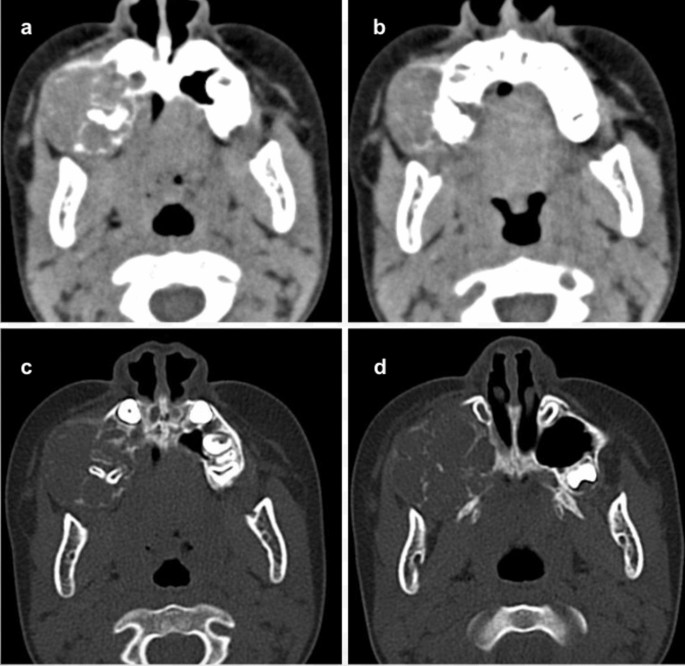 Small cell osteosarcoma in gnathic bones in the maxilla: case report in ...
