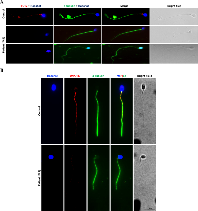 A novel homozygous missense TTC12 variant identified in an infertile Pakistani man with severe ...