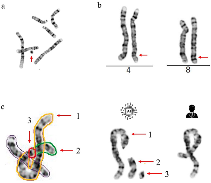 Clinical validation of artificial intelligence-assisted karyotyping on ...