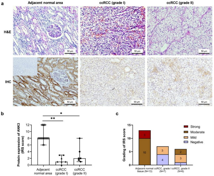 Downregulation of ankyrin 3 (ANK3) promotes malignant behaviors ...
