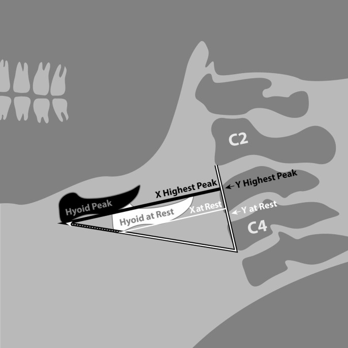 Palpation as a Method To Predict Spatial Instrumental Hyolaryngeal ...