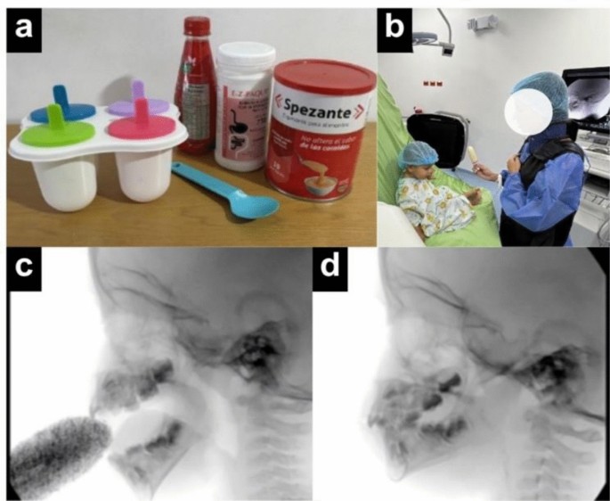 Pediatric Severe Oropharyngeal Dysphagia: A Clinical Challenge ...