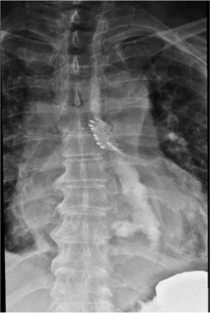 Evaluation of postoperative esophagram following peroral endoscopic ...