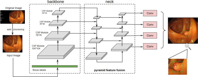 Evaluation efficacy and accuracy of a real-time computer-aided polyp ...