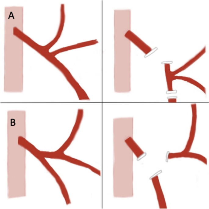 Modification of the vascular preparation after high tie ligation to ...