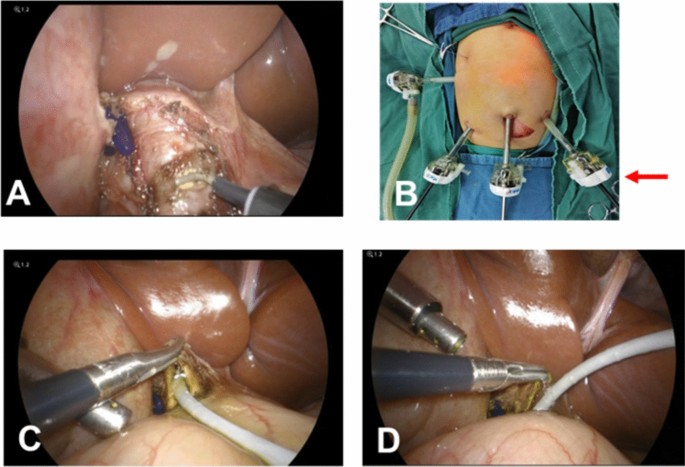 Laparoscopy combined with intraoperative choledochoscopy for the ...