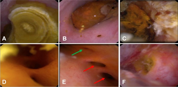 Laparoscopy combined with intraoperative choledochoscopy for the ...