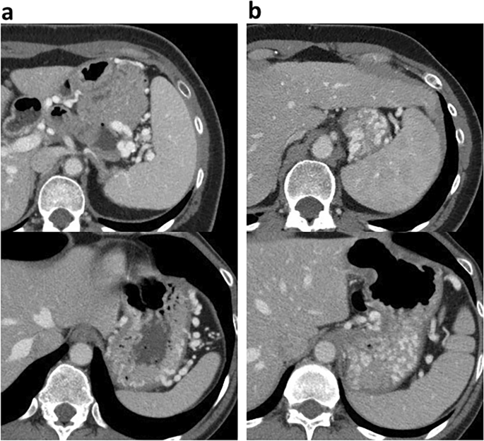 Short- and long-term outcomes after minimally invasive spleen ...