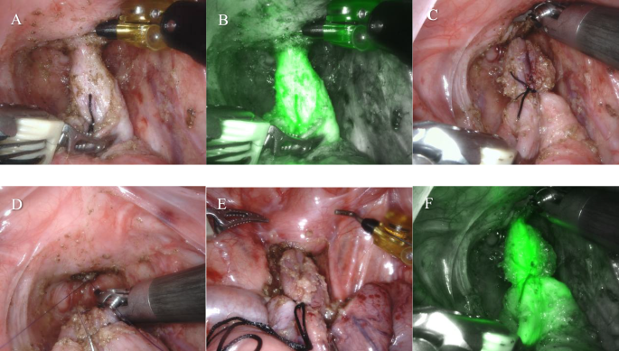 Comparison of robotic-assisted and laparoscopic-assisted anorectal pull-through for anorectal ...