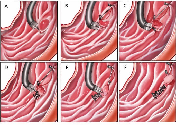 Zipper endoscopic full-thickness resection: a pilot study in ...
