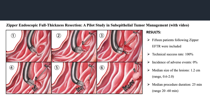 Zipper endoscopic full-thickness resection: a pilot study in ...