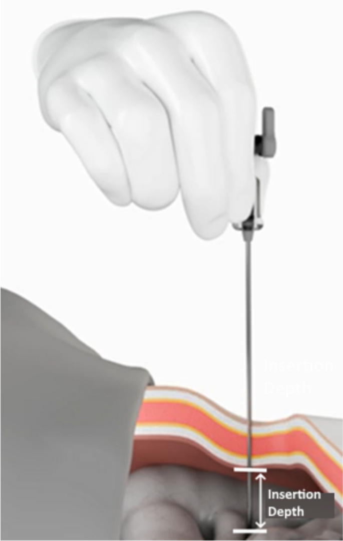 Learning curve estimation and insertion depth in Veress needle ...